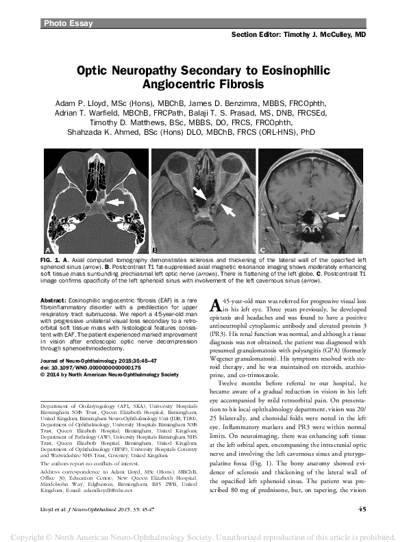 (PDF) Optic neuropathy secondary to eosinophilic angiocentric fibrosis