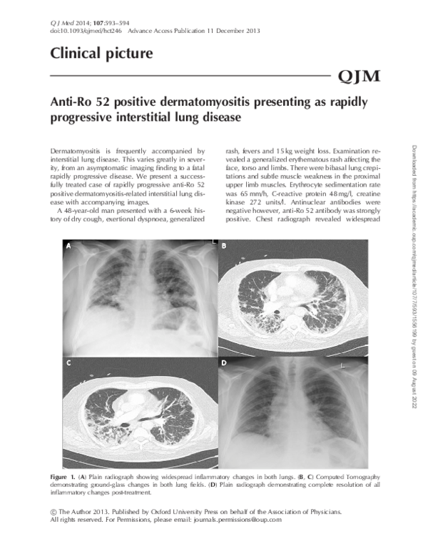 (PDF) Anti-Ro 52 positive dermatomyositis presenting as rapidly ...