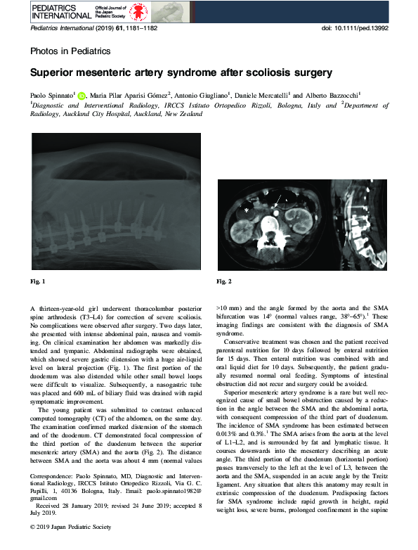 (PDF) Superior mesenteric artery syndrome after scoliosis repair ...
