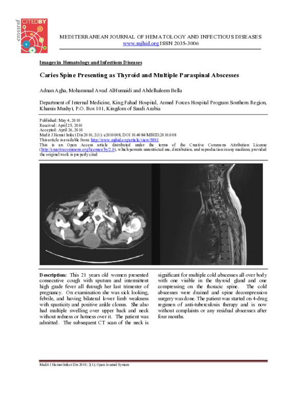 (PDF) Caries spine presenting as Thyroid and multiple paraspinal abscesses