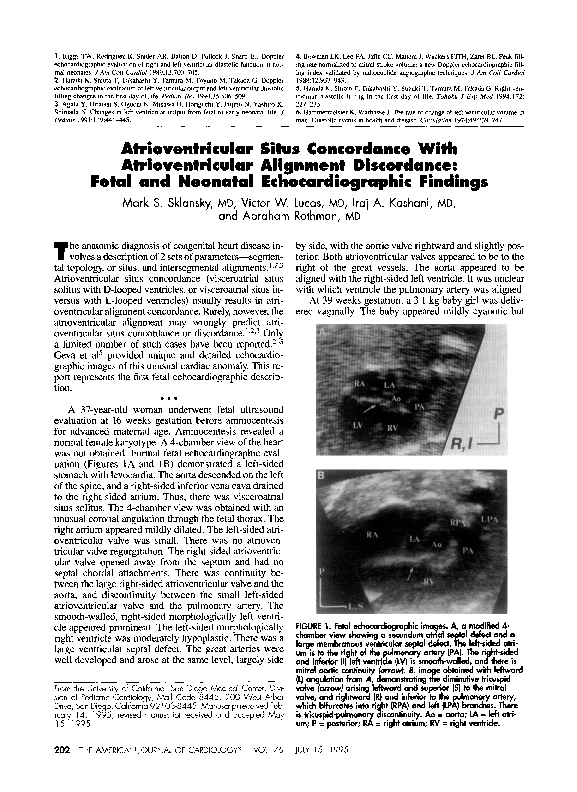 (PDF) Atrioventricular situs concordance with atrioventricular ...