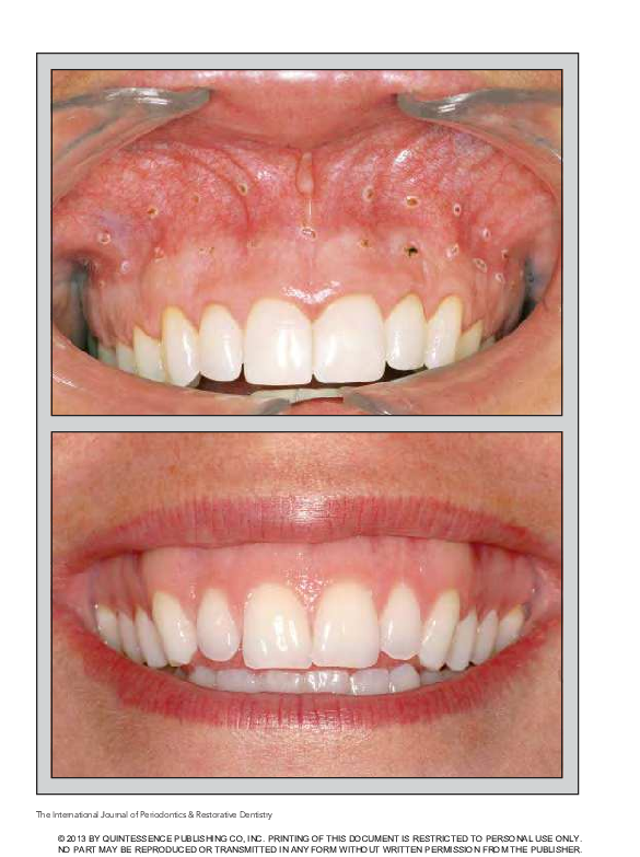 (PDF) Lip Repositioning with Reversible Trial for the Management of ...