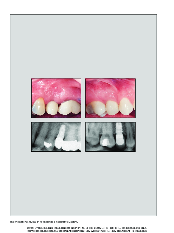 (PDF) The Effect of Platform-Switching Plus Laser Grooving on Peri ...
