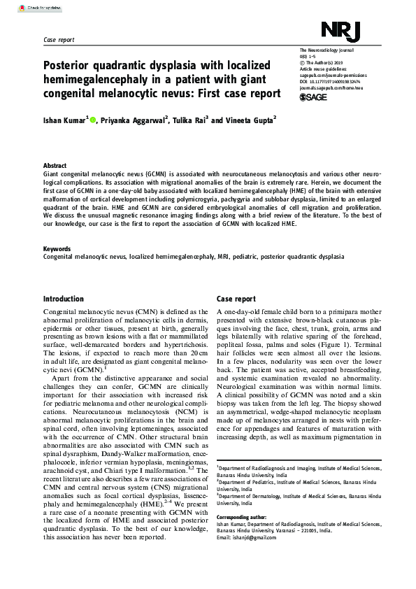 (PDF) Posterior quadrantic dysplasia with localized hemimegalencephaly ...