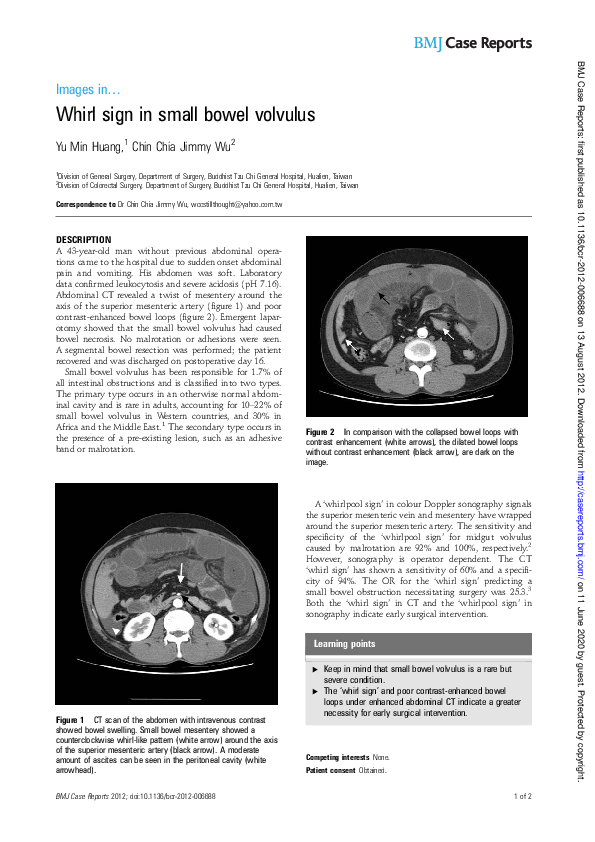 (PDF) Whirl sign in small bowel volvulus