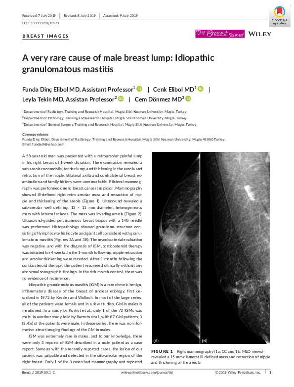 (PDF) A very rare cause of male breast lump: Idiopathic granulomatous ...