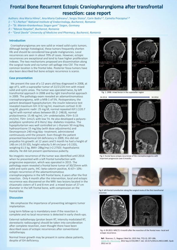 (PDF) Frontal bone recurrent ectopic craniopharyngioma after ...