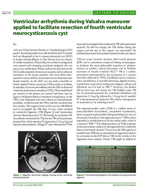 (PDF) Ventricular arrhythmia during Valsalva maneuver applied to ...