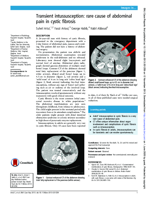 (PDF) Transient intussusception: rare cause of abdominal pain in cystic ...