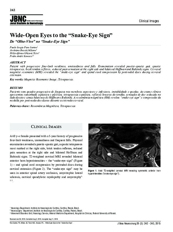 (PDF) Wide-Open Eyes to the “Snake-Eye Sign”