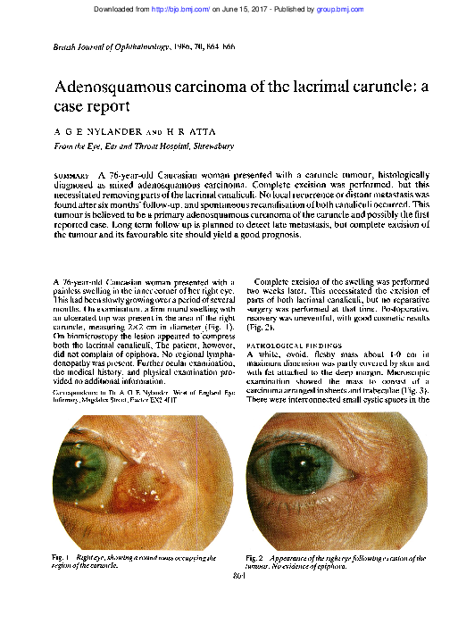 (PDF) Adenosquamous carcinoma of the lacrimal caruncle: a case report