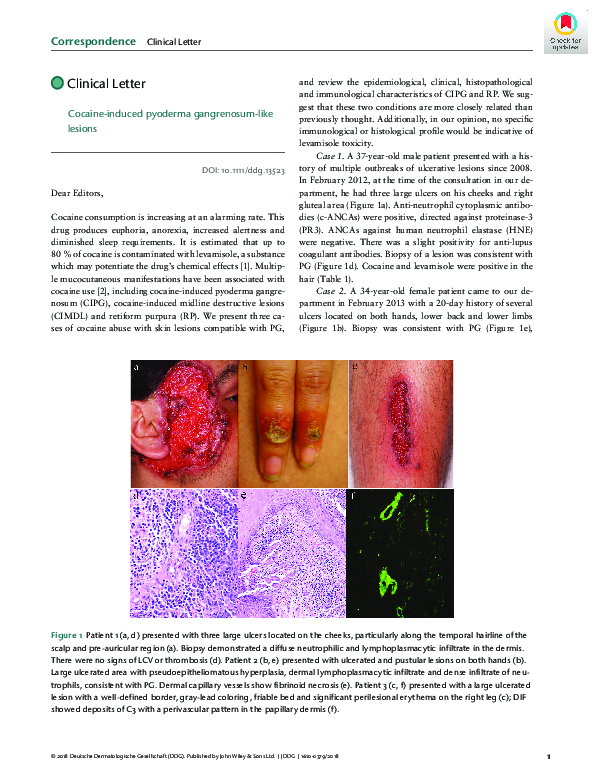 (PDF) Cocaine-induced pyoderma gangrenosum-like lesions