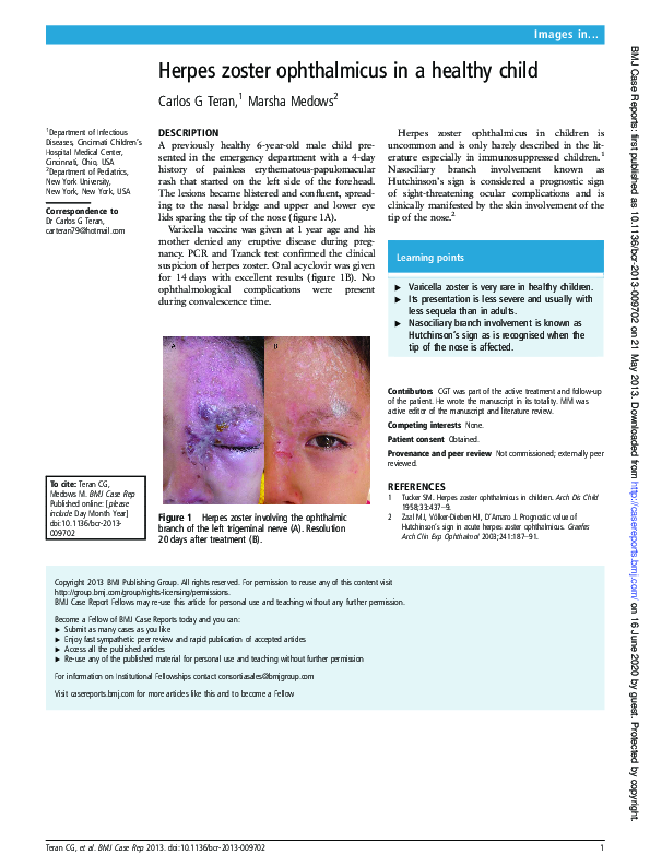 (PDF) Herpes zoster ophthalmicus in a healthy child