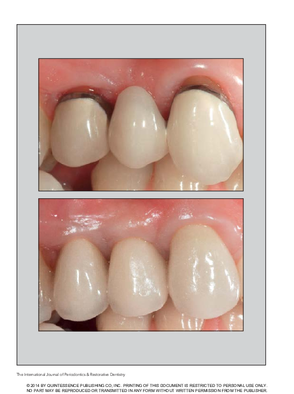 (PDF) Influence of Laser-Lok Surface on Immediate Functional Loading of Implants in Single-Tooth ...