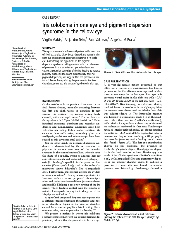 (PDF) Iris coloboma in one eye and pigment dispersion syndrome in the ...