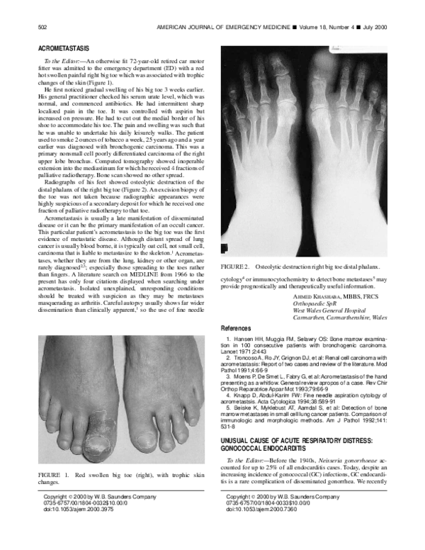 (PDF) Acrometastasis