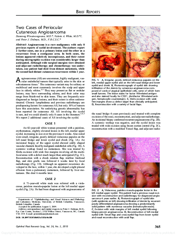 (PDF) Pseudodacryocystitis and Nasolacrimal Duct Obstruction Secondary ...