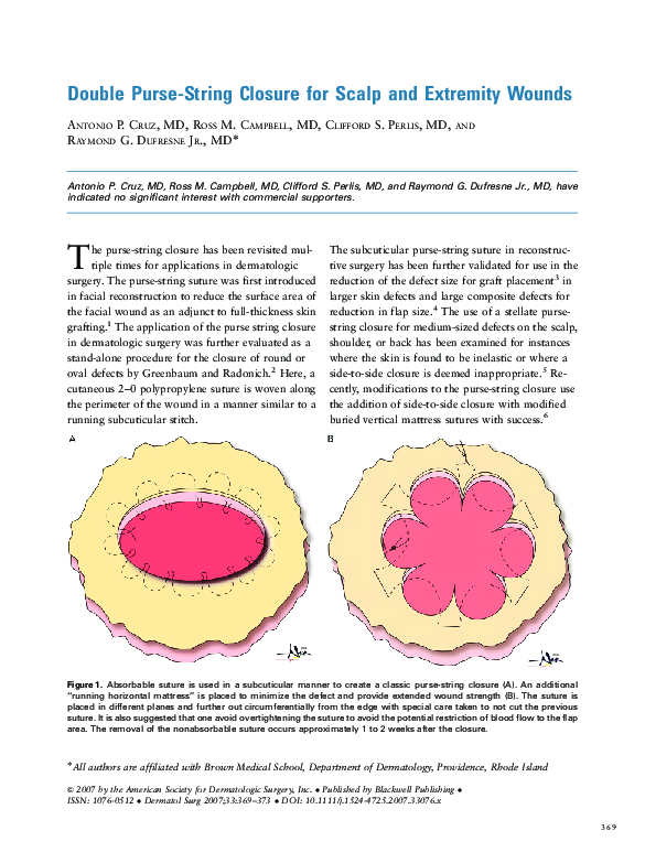 (PDF) Double Purse-String Closure for Scalp and Extremity Wounds