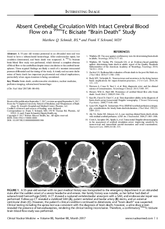 (PDF) Absent Cerebellar Circulation With Intact Cerebral Blood Flow on ...