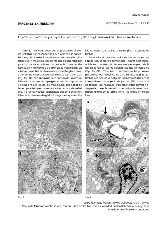 (PDF) Enfermedad glomerular por depósitos densos con patrón de glomerulonefritis difusa en media ...