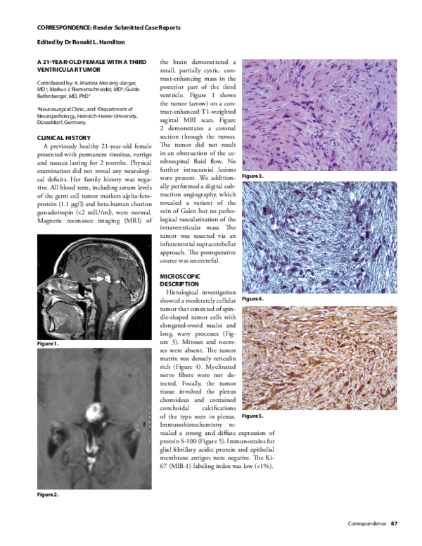 (PDF) A 21-YEAR-OLD Female with Athird Ventricular Tumor | Martina ...