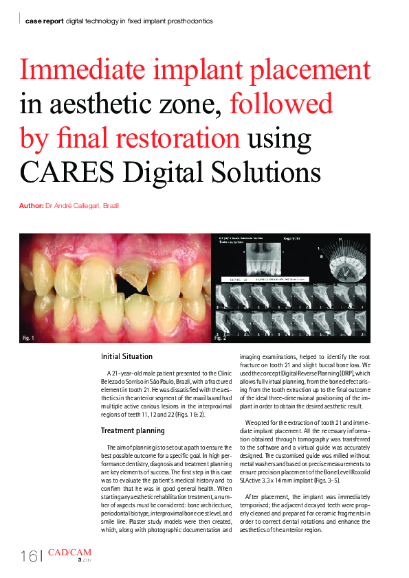 (PDF) Immediate Implant Placement in the Aesthetic Zone: A Multidisciplinary Management - Case ...