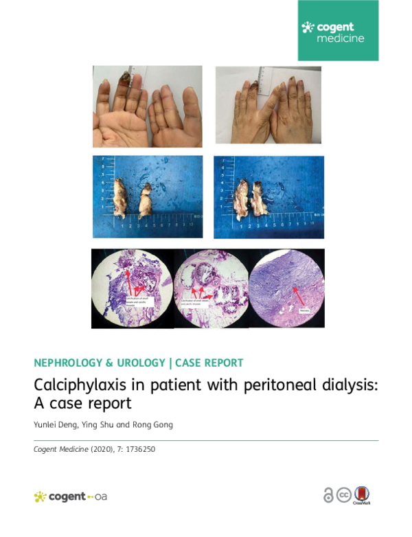 (PDF) Calciphylaxis in patient with peritoneal dialysis: A case report ...