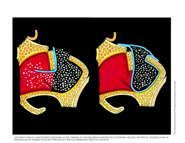 (PDF) The "Loma Linda pouch": a technique for repairing the perforated ...