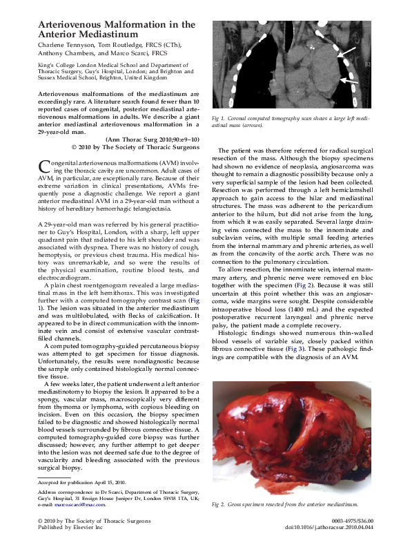 (PDF) Arteriovenous Malformation in the Anterior Mediastinum | Tom ...