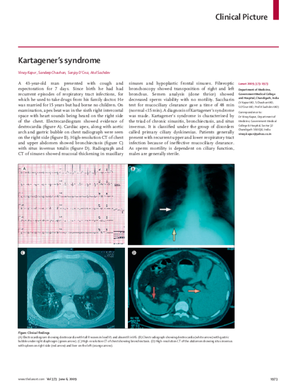 (PDF) Kartagener's syndrome
