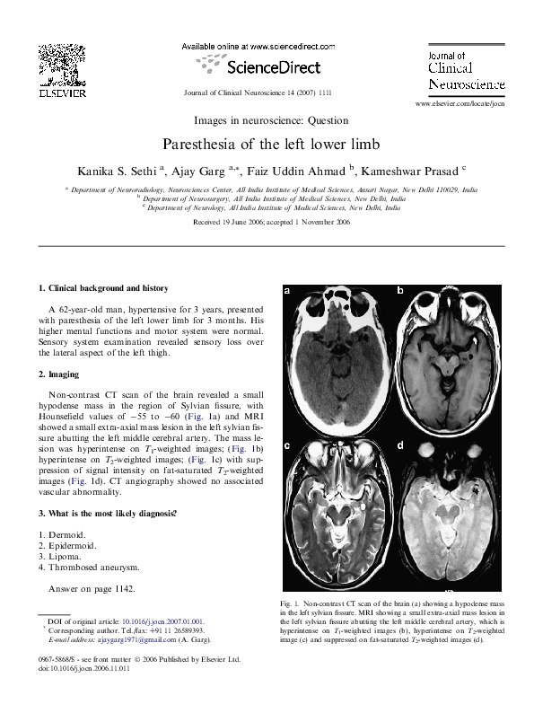 (PDF) Paresthesia of the left lower limb