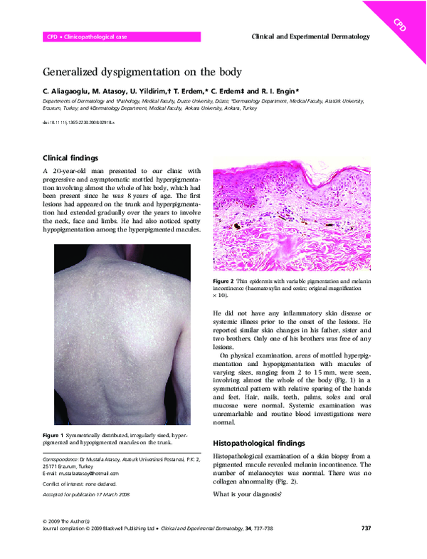 (PDF) Generalized dyspigmentation on the body