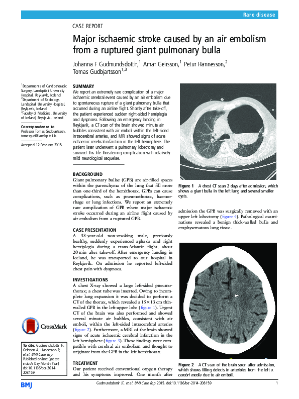 (PDF) Major ischaemic stroke caused by an air embolism from a ruptured ...