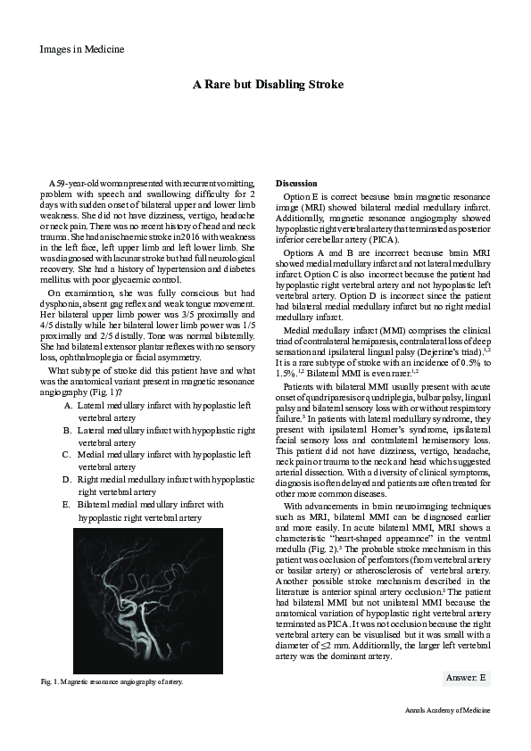 (PDF) A Rare but Disabling Stroke