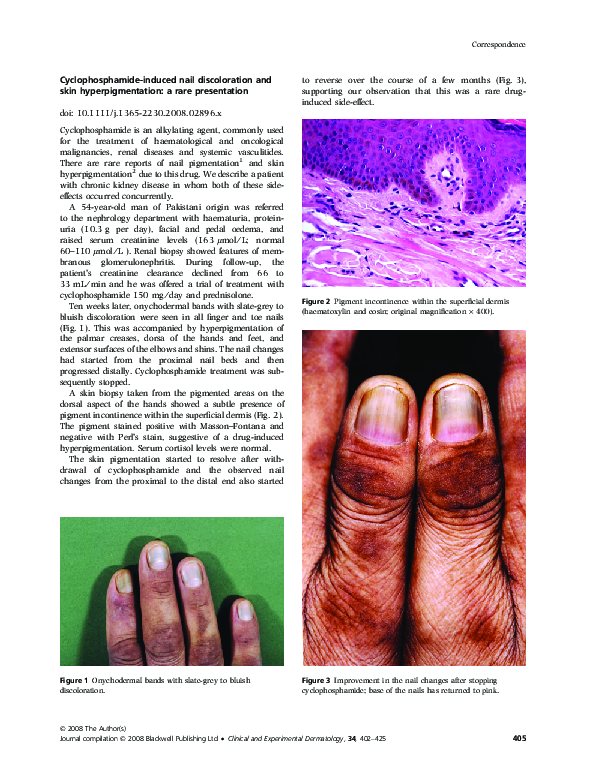 (PDF) Cyclophosphamide-induced nail discoloration and skin ...