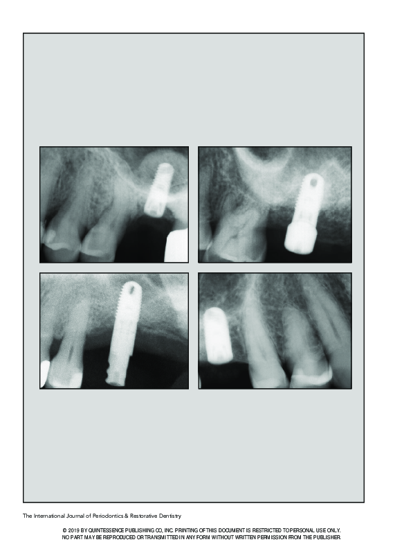 (PDF) Classification of Sinus Membrane Perforations Occurring During ...