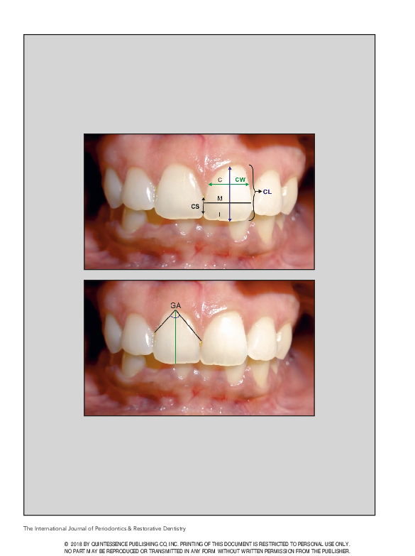 (PDF) Morphometric Variation in Maxillary Central Incisors and Its ...