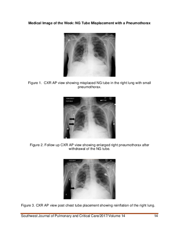 (PDF) Medical image of the week: NG tube misplacement with a pneumothorax