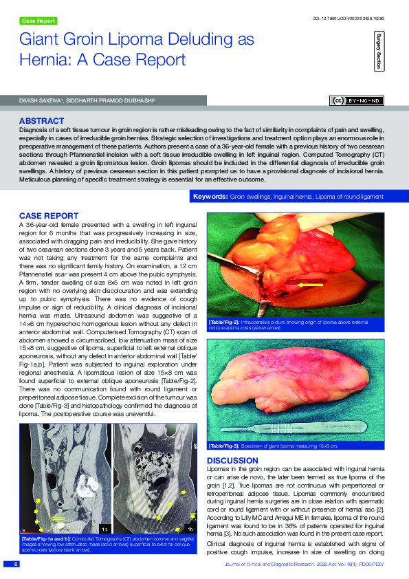 Pdf Giant Groin Lipoma Deluding As Hernia A Case Report