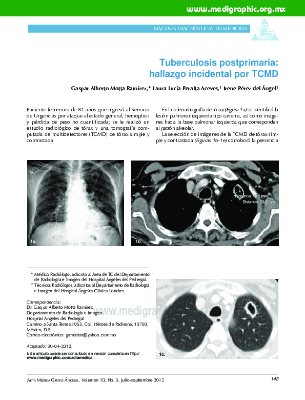(PDF) Tuberculosis postprimaria: hallazgo incidental por TCMD