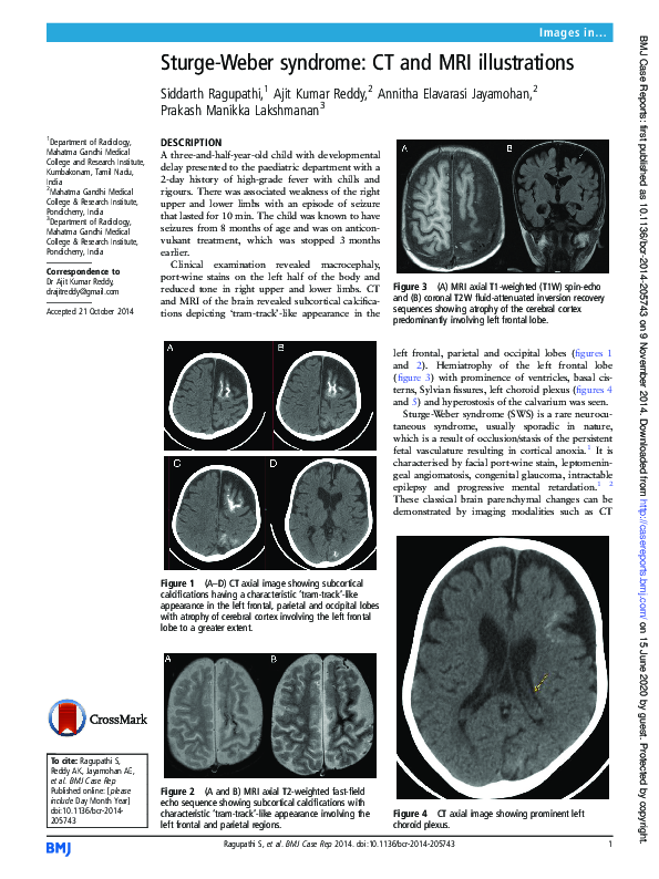 (PDF) Sturge-Weber syndrome: CT and MRI illustrations