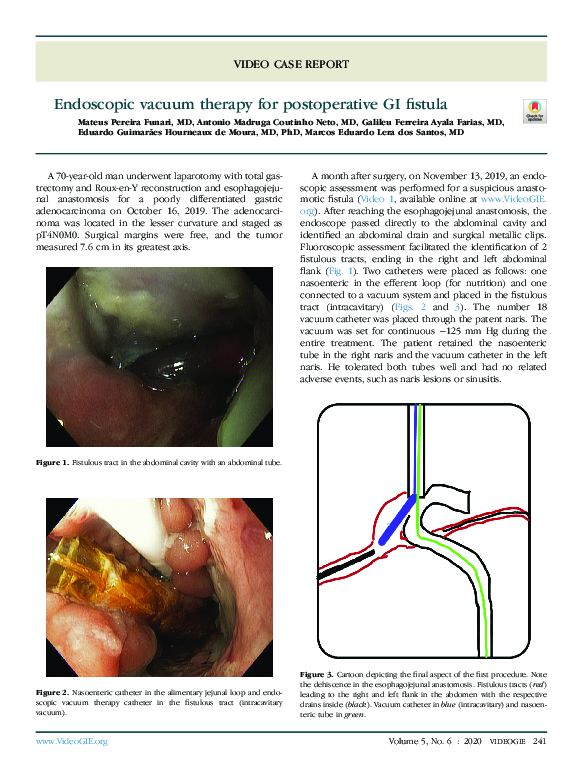 (PDF) Endoscopic vacuum therapy for postoperative GI fistula