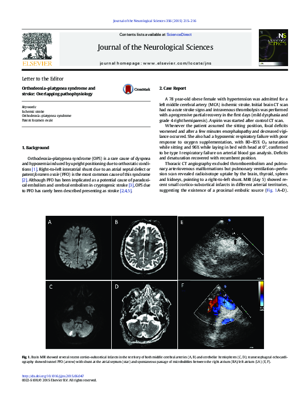 (PDF) Orthodeoxia-platypnea syndrome and stroke: Overlapping ...