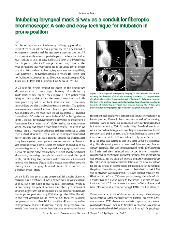 (PDF) Intubating laryngeal mask airway as a conduit for fiberoptic ...
