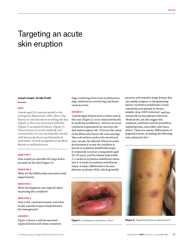 (PDF) Targeting an acute skin eruption