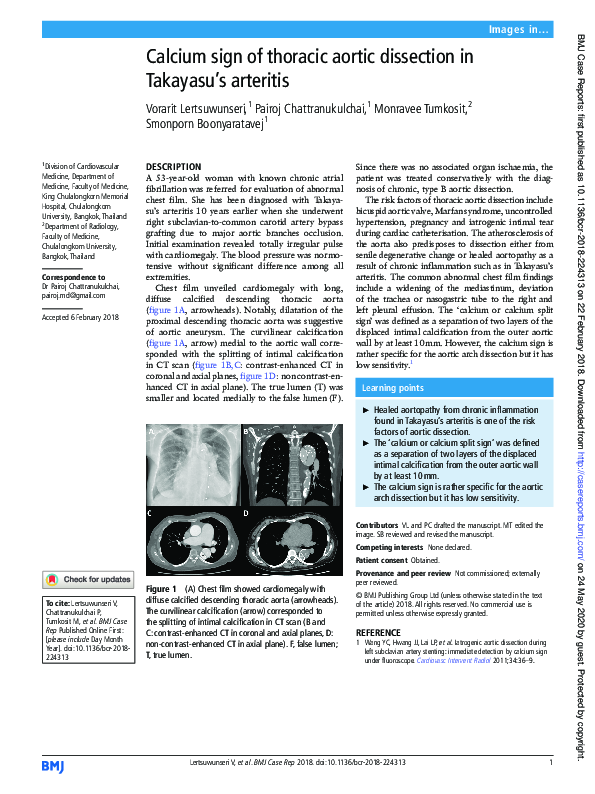 (PDF) Calcium sign of thoracic aortic dissection in Takayasu’s arteritis