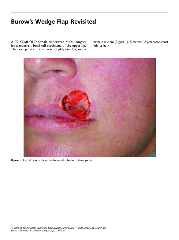 (PDF) Burow's Wedge Flap Revisited