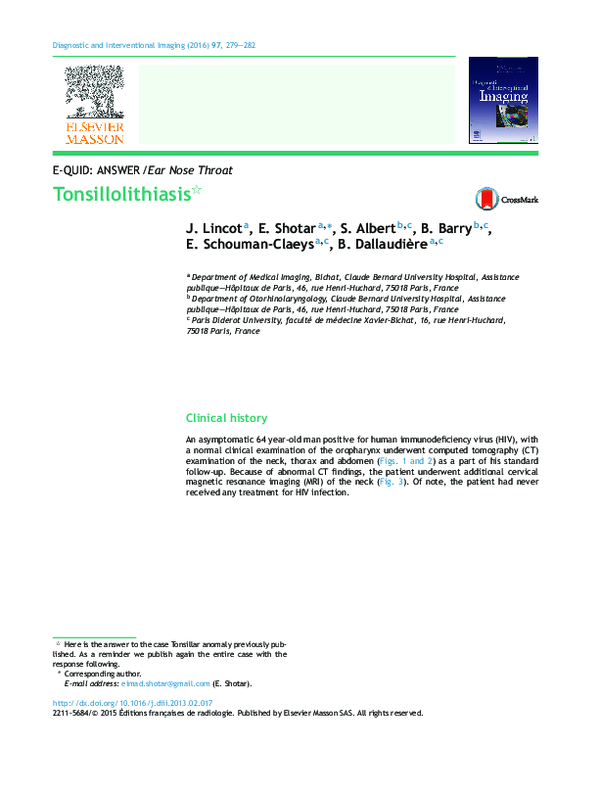 (PDF) Tonsillolithiasis