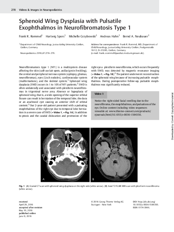 (PDF) Sphenoid Wing Dysplasia with Pulsatile Exophthalmos in ...