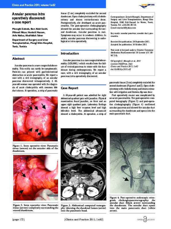 Pdf Annular Pancreas Intra Operatively Discovered A Case Report